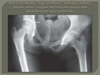 Tb hip knee shoulder dactylitis | PPTX