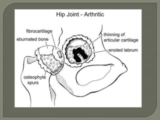 Tb hip knee shoulder dactylitis | PPTX