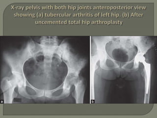 Tb hip knee shoulder dactylitis | PPTX