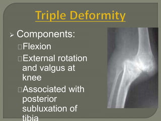 Tb hip knee shoulder dactylitis | PPTX