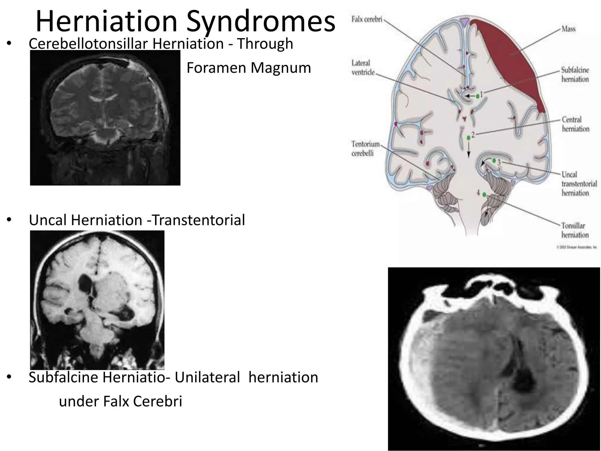 Traumatic brain injury-- anaesthetic implication | PPTX