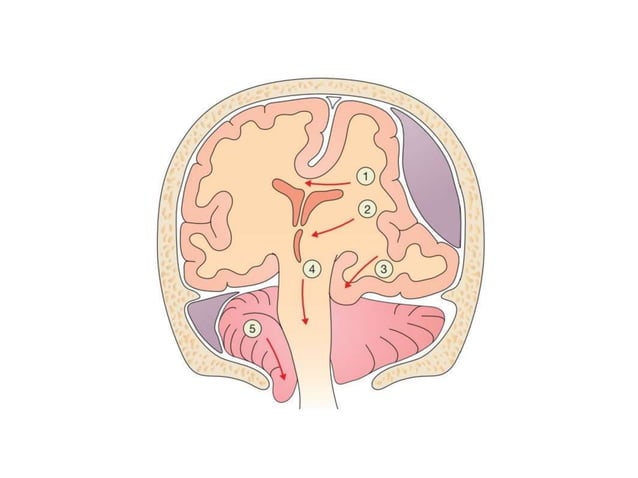 TBI definion and their types well explained | PPT