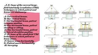 TBI.pptx total body irradiation radiotherapy | PPTX