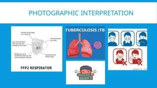 Tuberculosis in IC, case identification & control measures | PPT