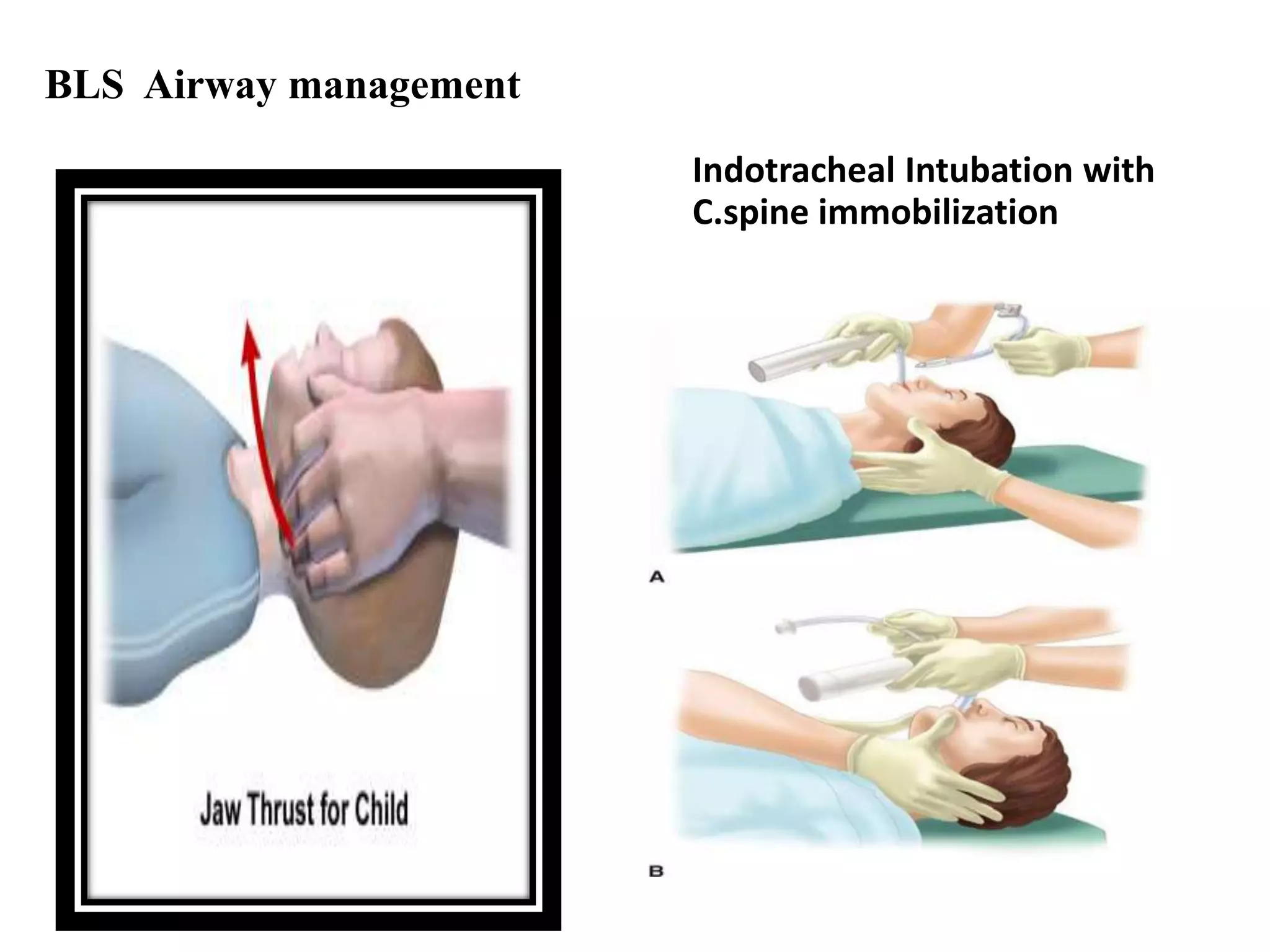 TBI IN PEDIATRICS .pptx