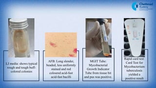 TB in Elbow Joint.pptx