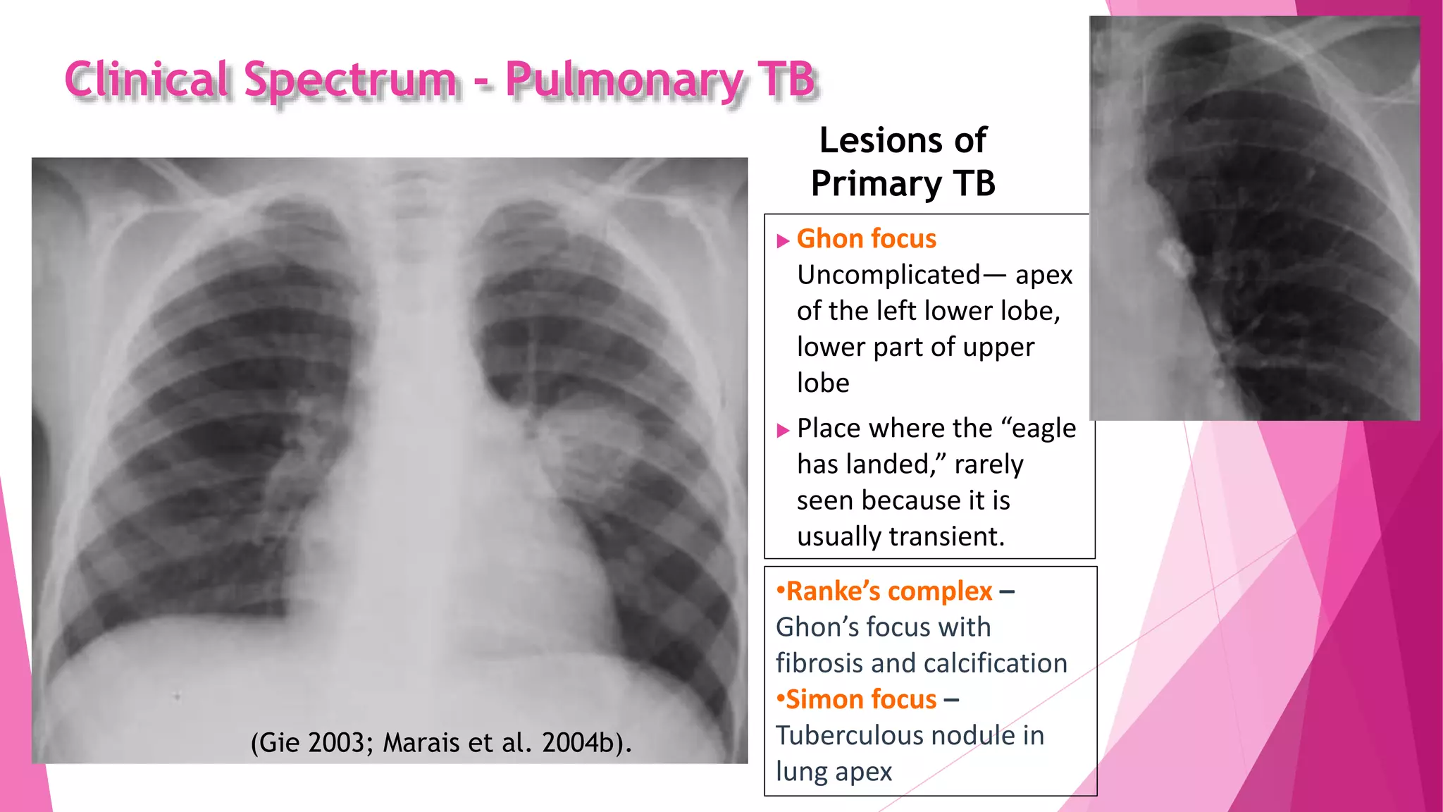 TB in pediatrics | PPTX