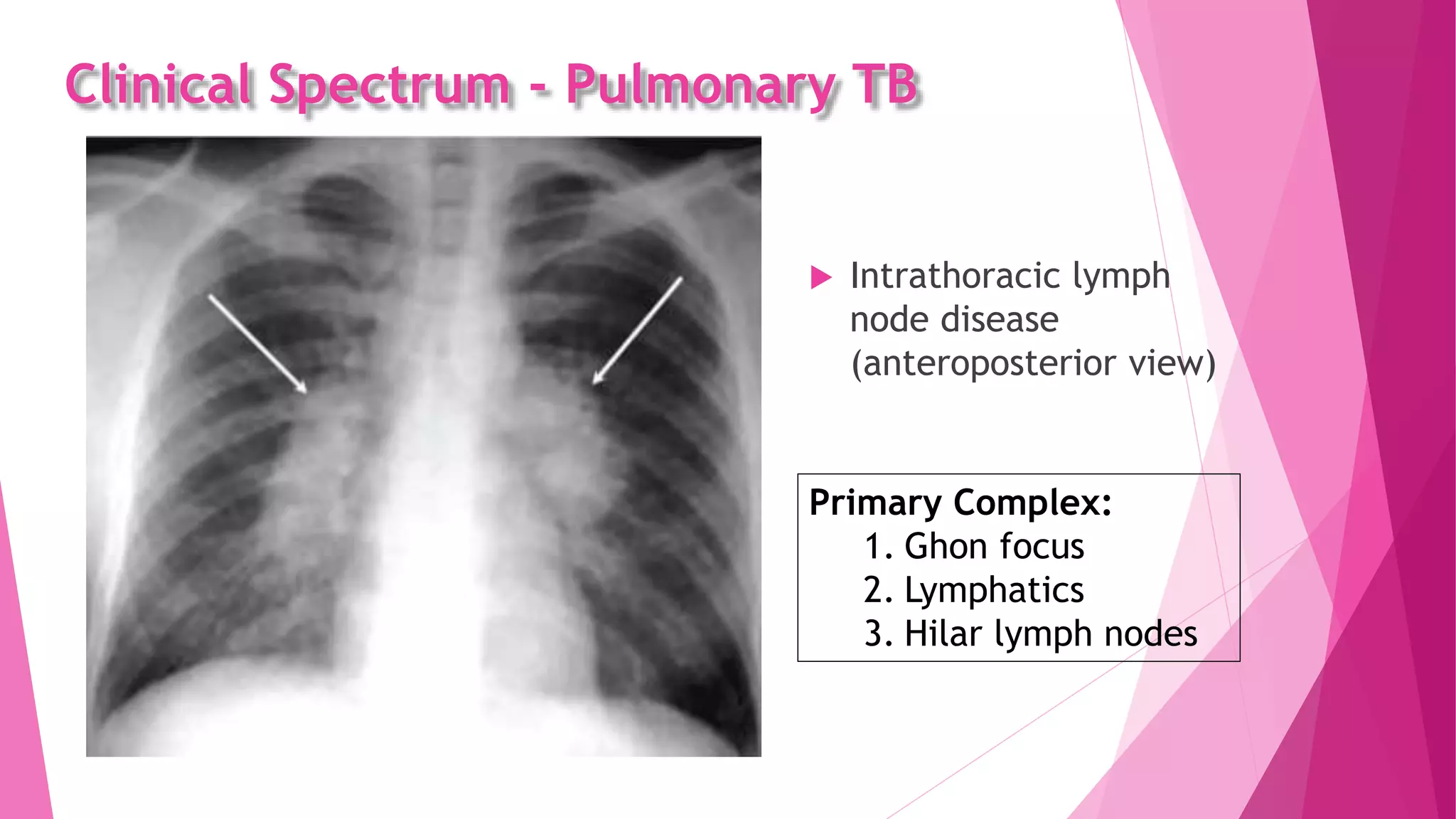 TB in pediatrics | PPTX