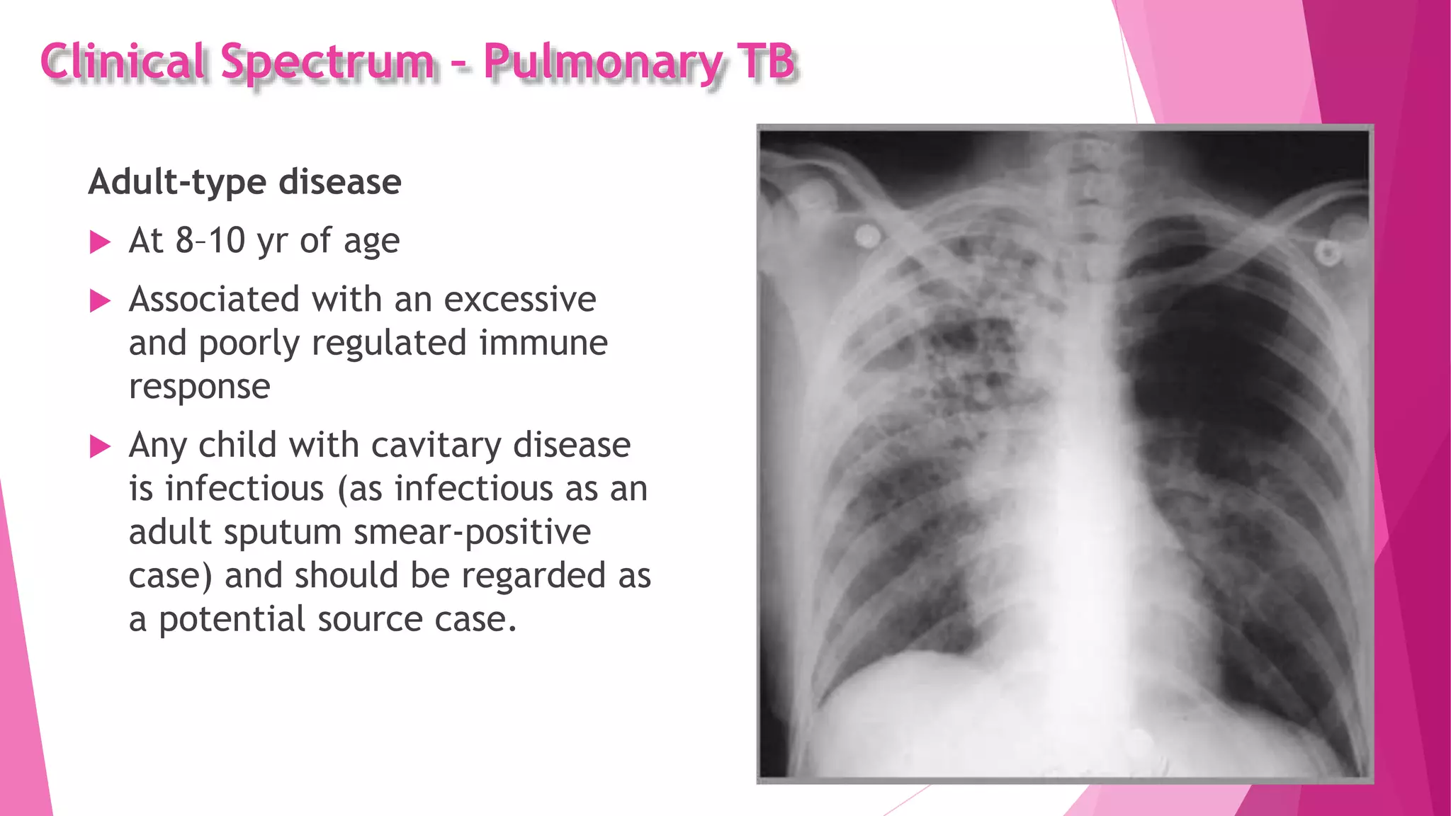 TB in pediatrics | PPTX