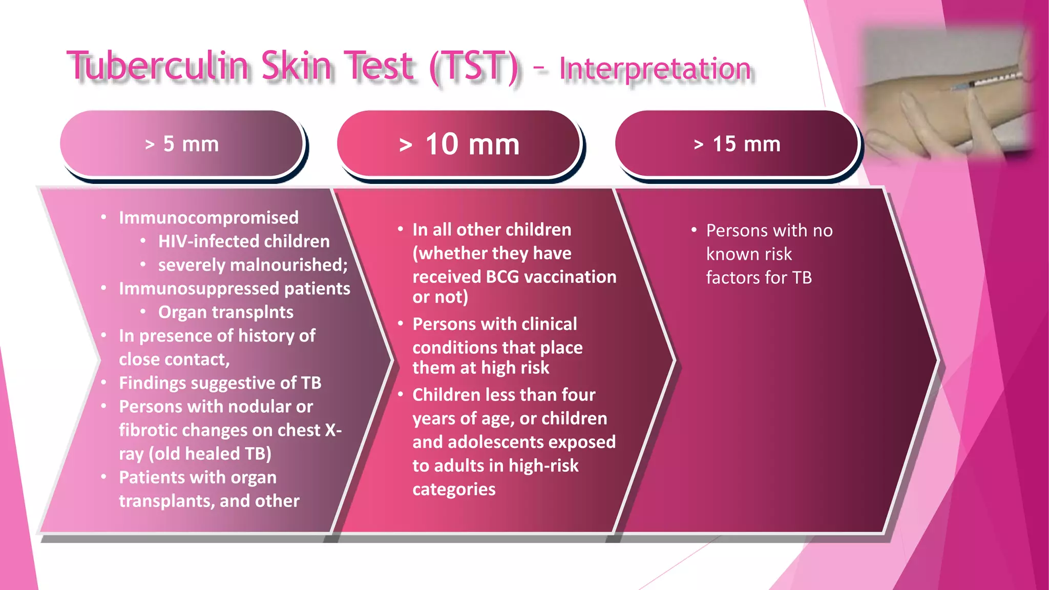 TB in pediatrics | PPTX
