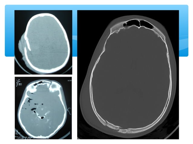 Traumatic Brain Injury: Approach | PPT