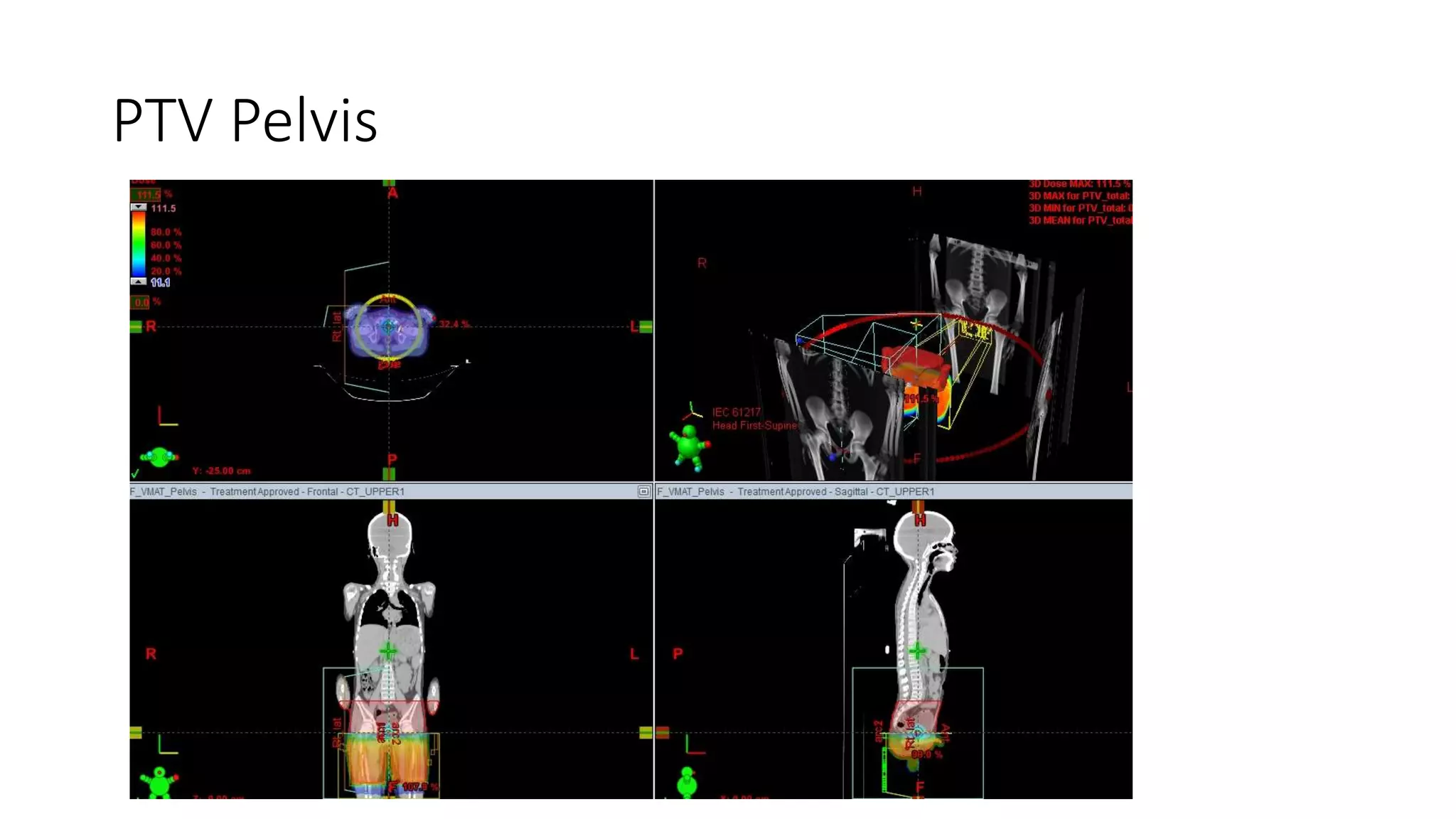 Total Body Irradiation (TBI) Planning | PPTX