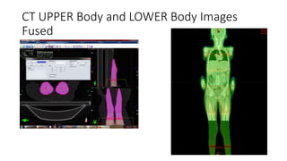 Total Body Irradiation (TBI) Planning | PPTX