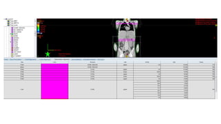 Total Body Irradiation (TBI) Planning | PPTX