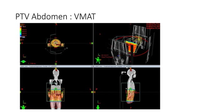 Total Body Irradiation (TBI) Planning | PPTX