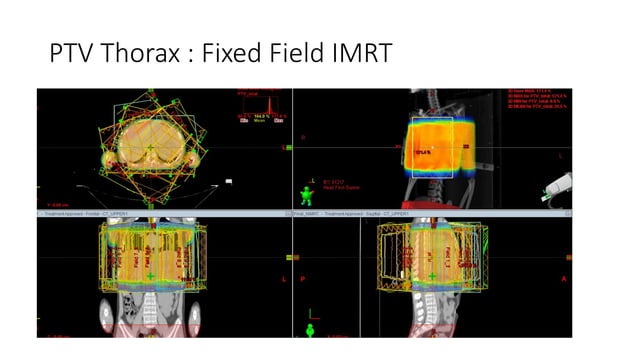 Total Body Irradiation (TBI) Planning | PPTX