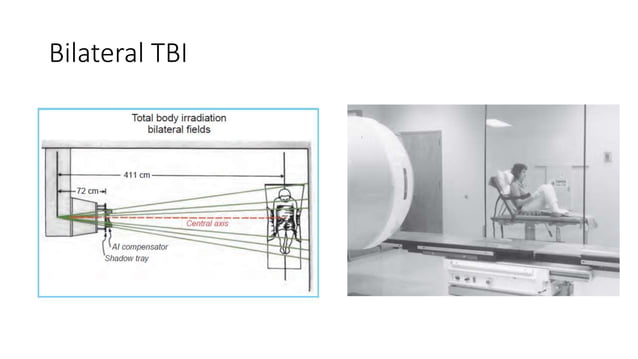 Total Body Irradiation (TBI) Planning | PPT