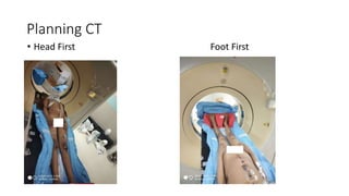 Total Body Irradiation (TBI) Planning | PPTX