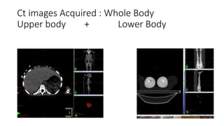 Total Body Irradiation (TBI) Planning | PPTX