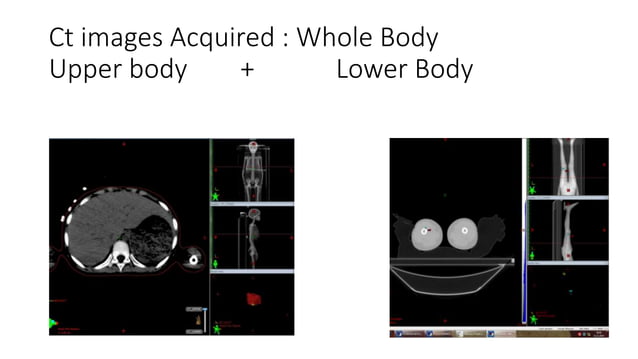 Total Body Irradiation (TBI) Planning | PPT