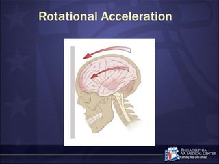 Rotational Acceleration Brain Injury