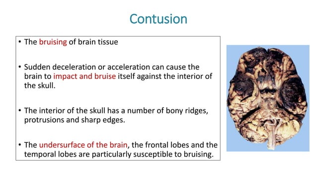 Traumatic Brain Injury to temporal lobe and cognitive rehabilitation | PPT