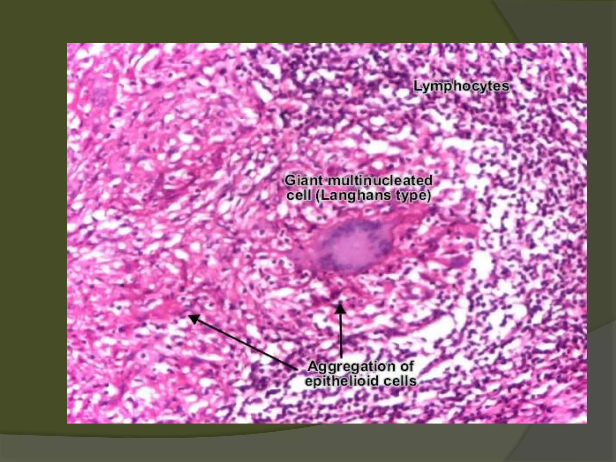 Tb lymphnode, tuberculoid and lepromatous leprosy | PPTX