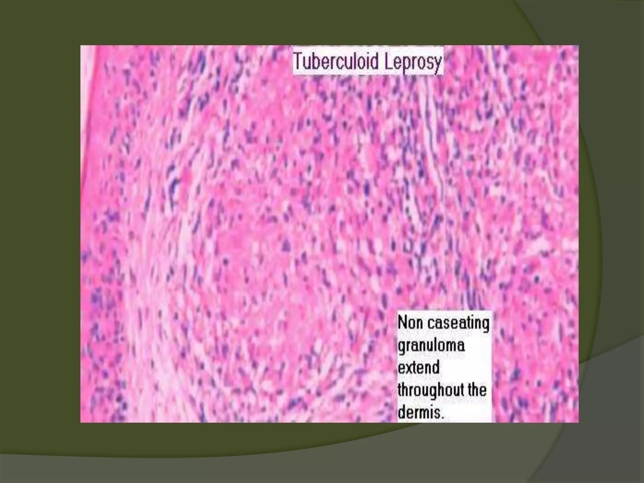 Tb lymphnode, tuberculoid and lepromatous leprosy | PPTX