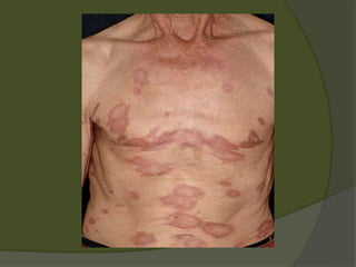 Tb lymphnode, tuberculoid and lepromatous leprosy | PPTX