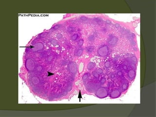 Tuberculosis Histology Labeled