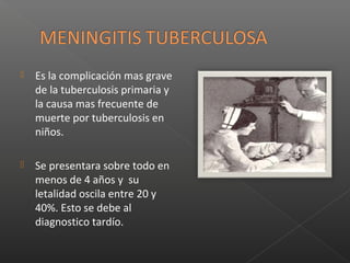 Tb meningea | PPT