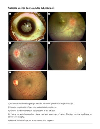tuberculosis ocular uptodate actualizacion.pdf