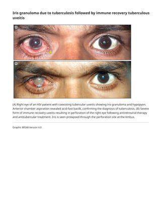 tuberculosis ocular uptodate actualizacion.pdf