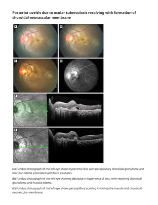 tuberculosis ocular uptodate actualizacion.pdf
