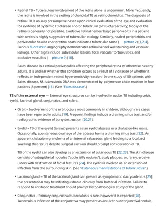 tuberculosis ocular uptodate actualizacion.pdf