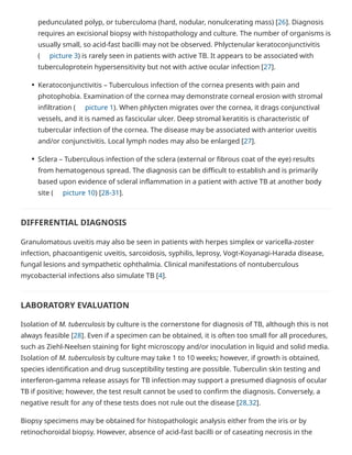 tuberculosis ocular uptodate actualizacion.pdf