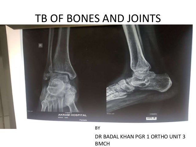 Tb of bones and joints