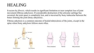 TB OF BONES AND JOINTS - ORTHOPEDICS.pptx