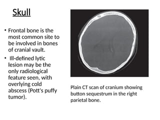 TB of bones and joints dewdewdewdwedewdsdw | PPTX