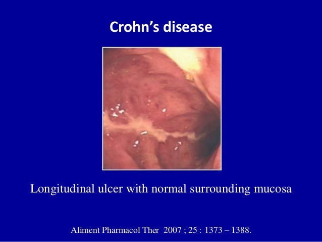 Aphthous Ulcers Crohns
