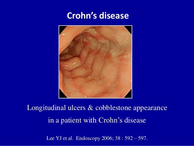 TB or not TB: a diagnostic challenge