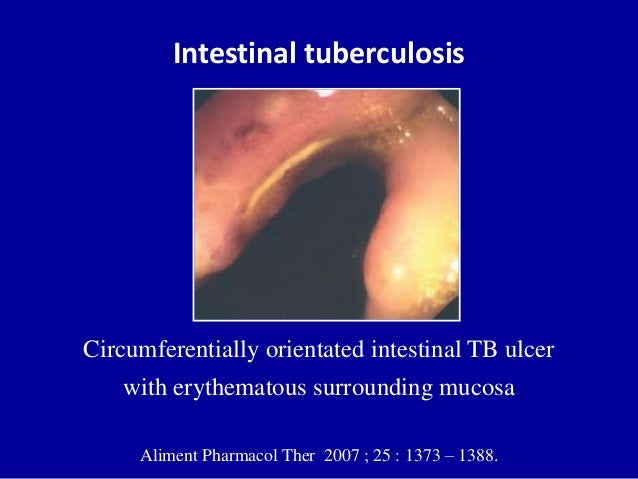 TB or not TB: a diagnostic challenge