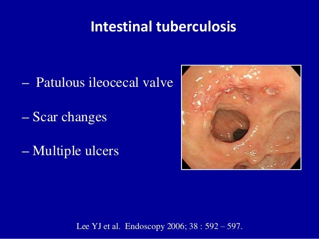 TB or not TB: a diagnostic challenge