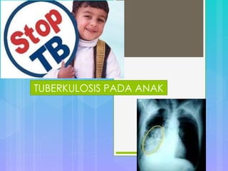 konsep dasar tuberkulosis pada Anak.pptx