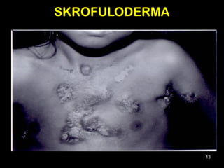 TUBERKULOSIS PARU PADA ANAK MATERI .pptx