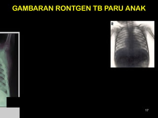 TUBERKULOSIS PARU PADA ANAK MATERI .pptx