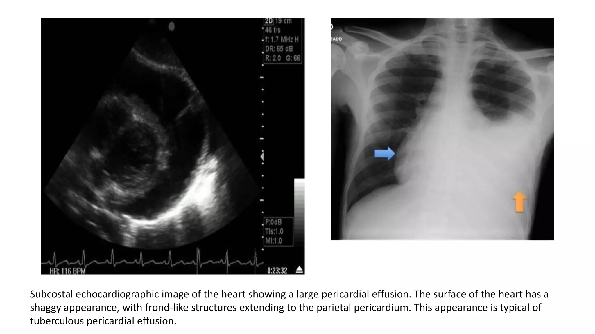 TB Pericarditis.pptx