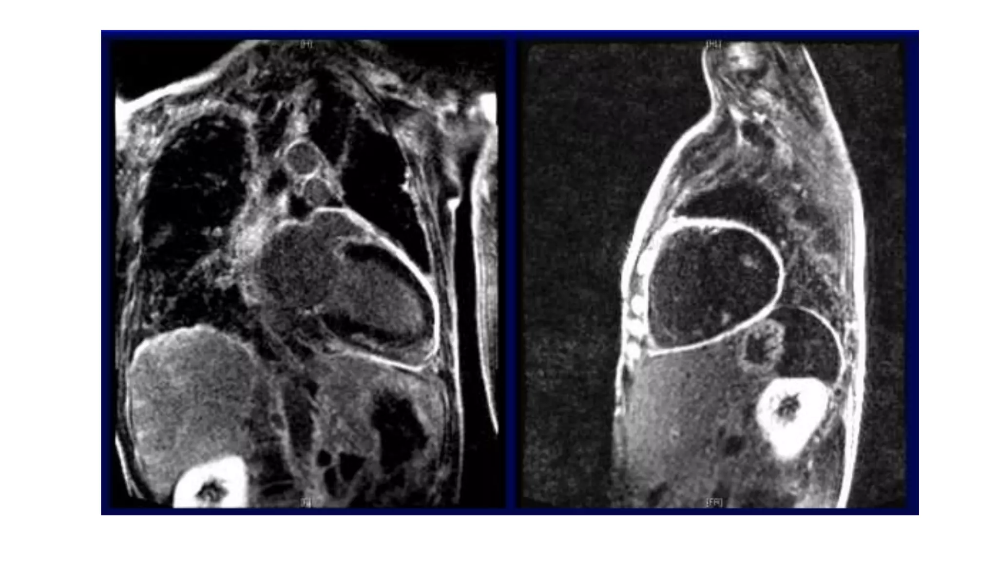 TB Pericarditis.pptx