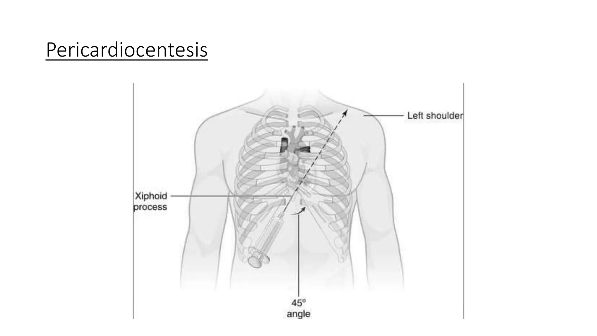 TB Pericarditis.pptx