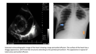 TB Pericarditis.pptx